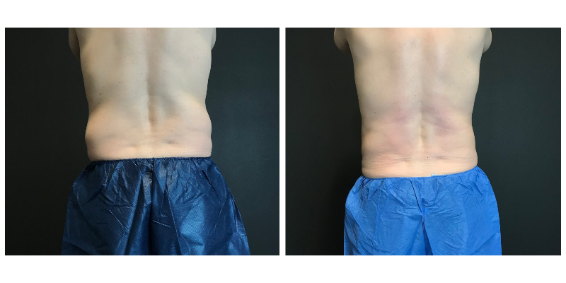 CoolSculpting - Cool Contours