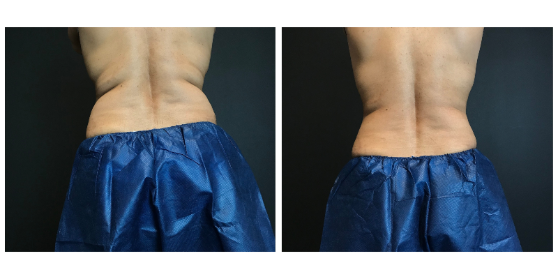 CoolSculpting - Cool Contours
